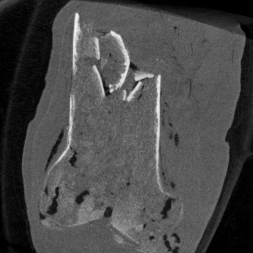 Multiplanar Reconstruction (MPR)