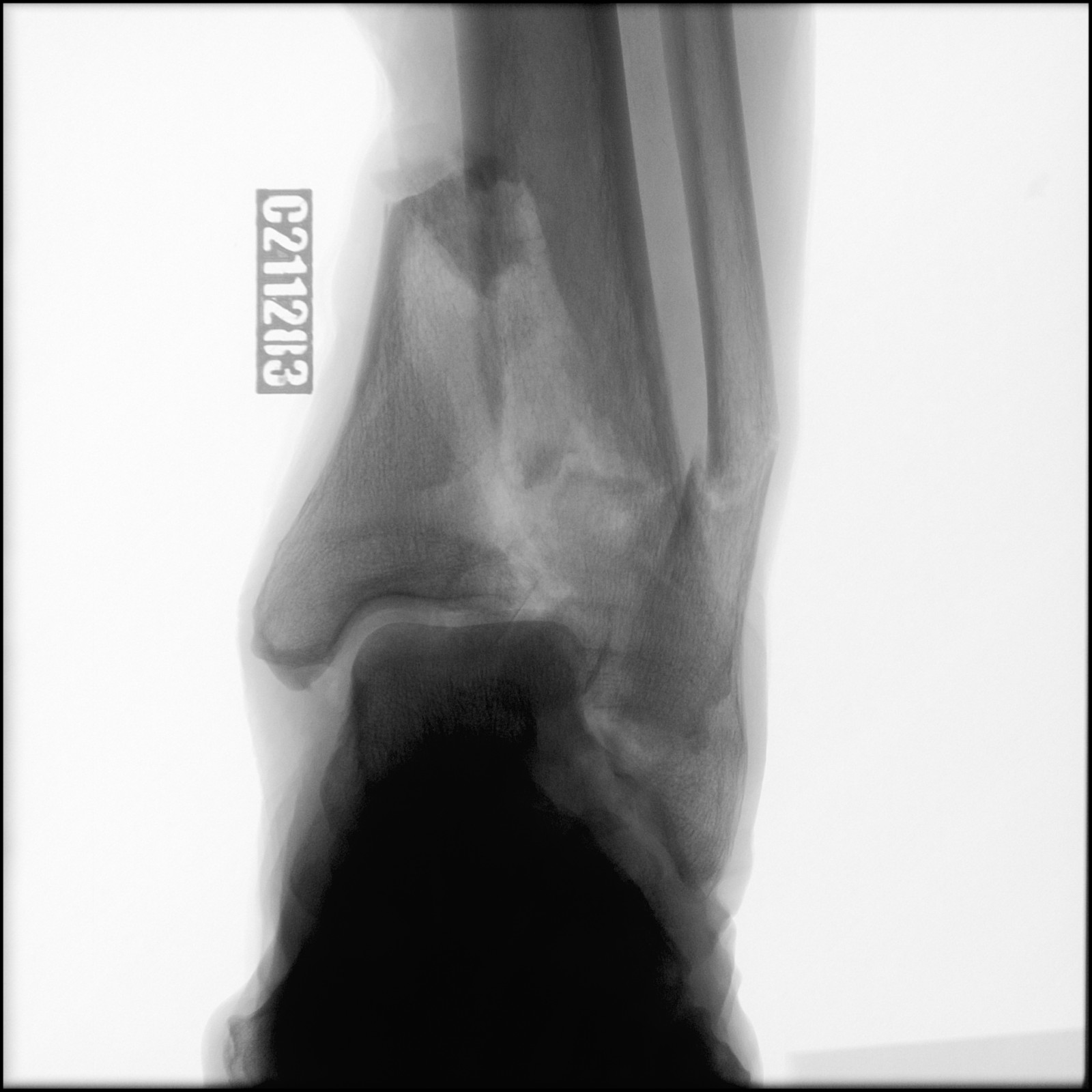 Preview: Fracture of Distal Tibia/Fibula - Left
